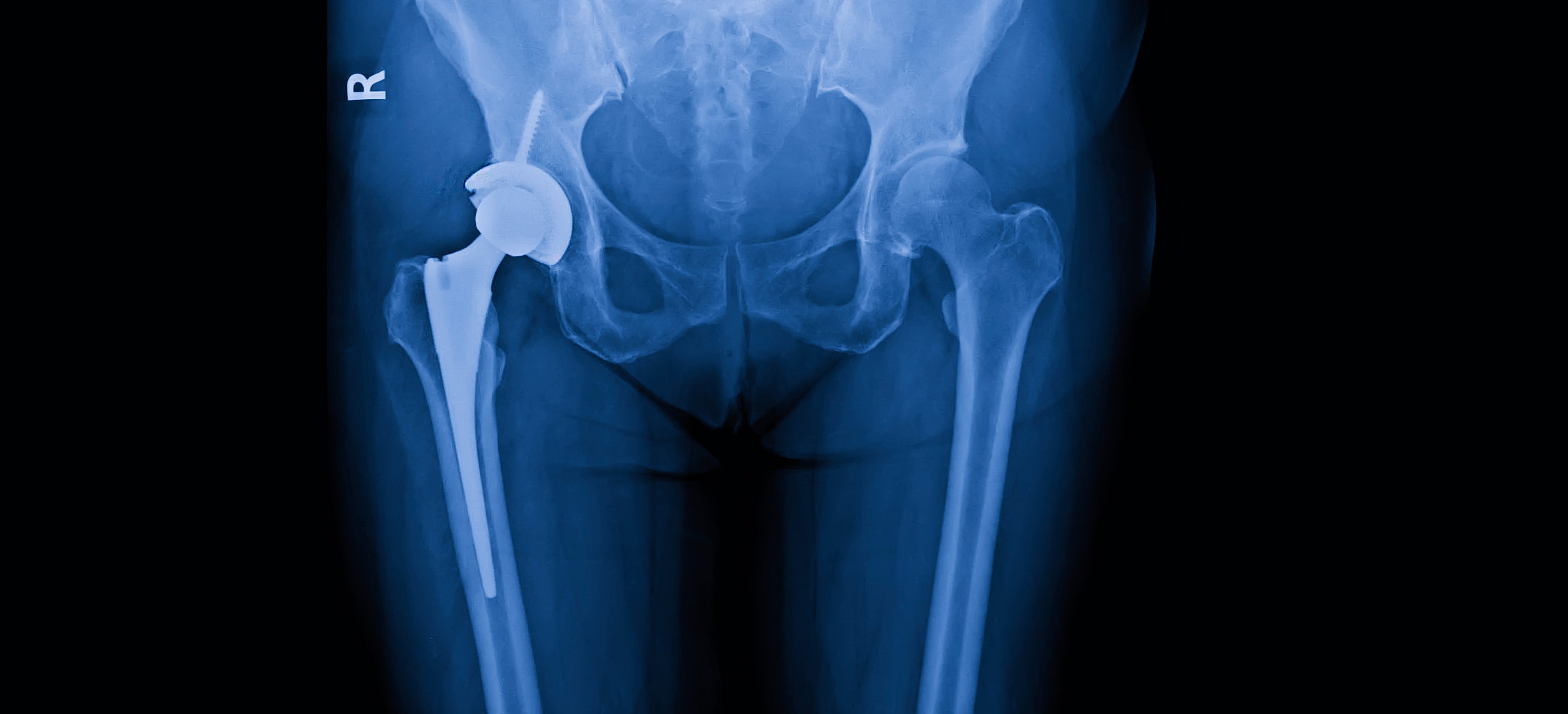 Lawsuits Mount Over Biomet Hip Implant Recall | 3/17/2025